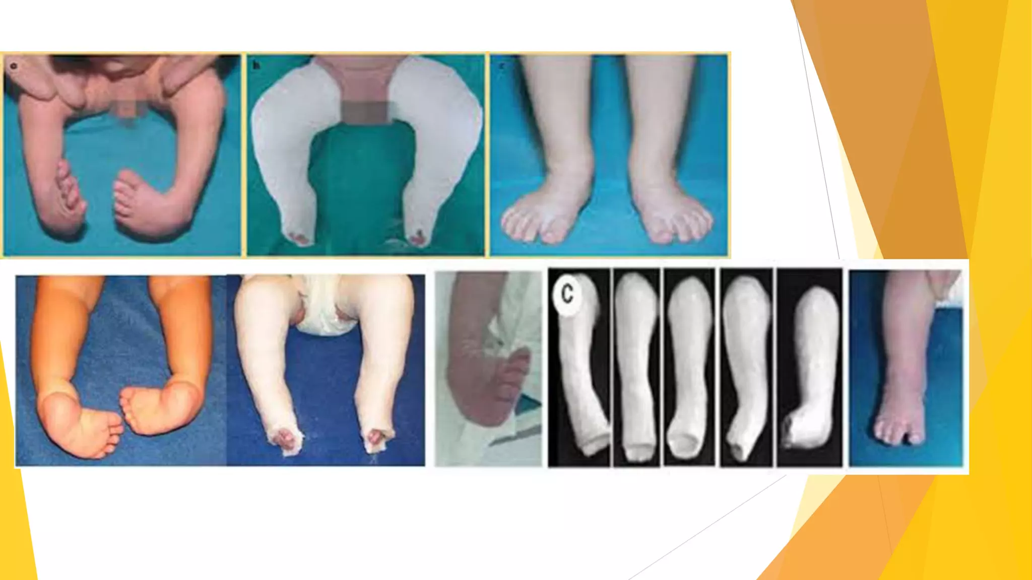 Pie equino varo | PPTX