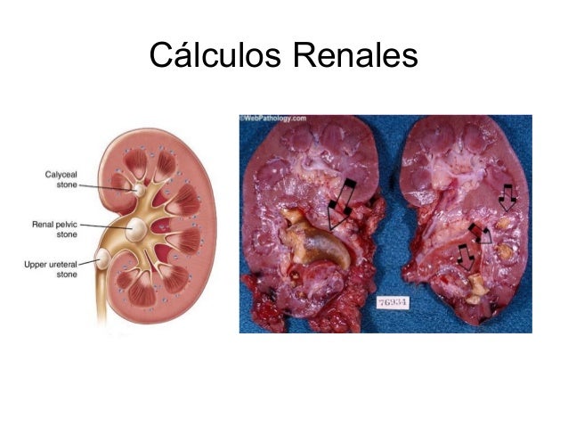 Pielocaliectasia renal