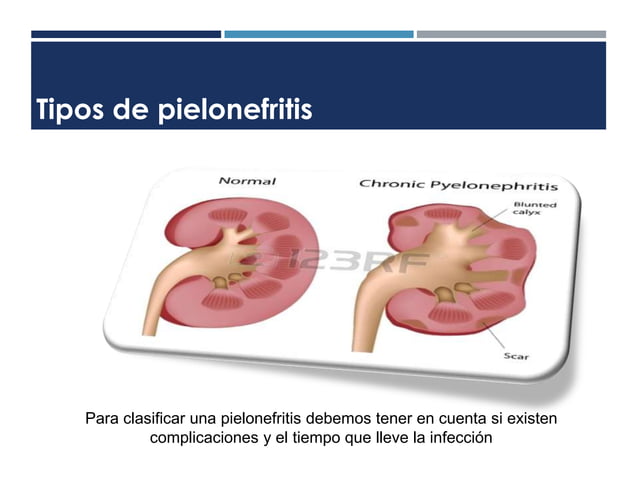 PIELONEFRITIS, ETIOLOGIA,FUNCIONES RENALES,EPIDEMIOLOGIA, ETIOLOGIA ...