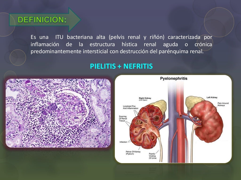 PIELONEFRITIS