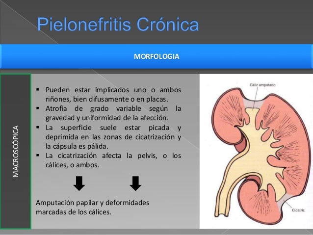 Pielonefritis