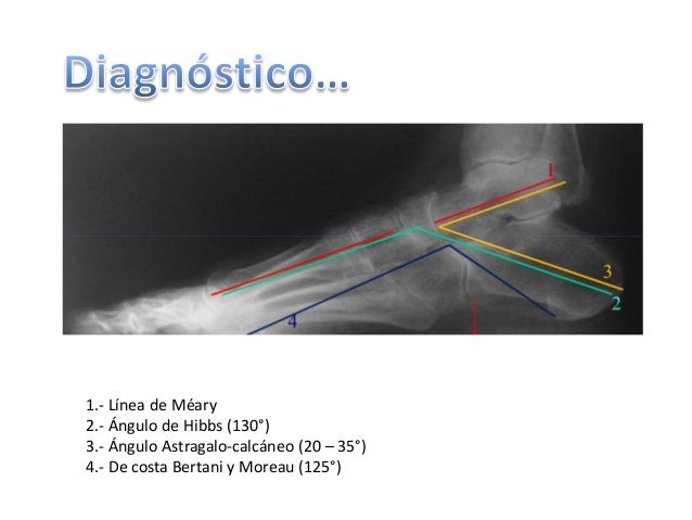 Diagnóstico de Pie Plano
