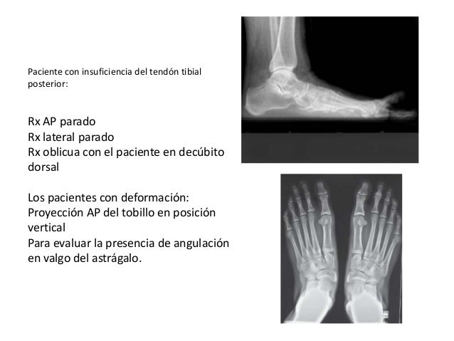 Diagnóstico de Pie Plano