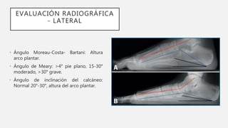 Pie plano del adulto.pptx