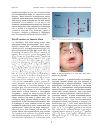 Pierre robin syndrome_a_case_report_and_review_of_ | PDF