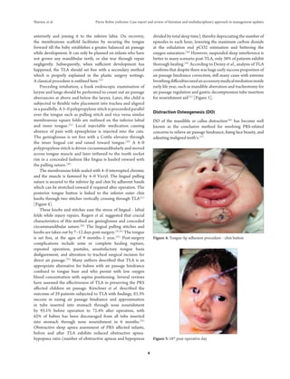 Pierre robin syndrome_a_case_report_and_review_of_ | PDF