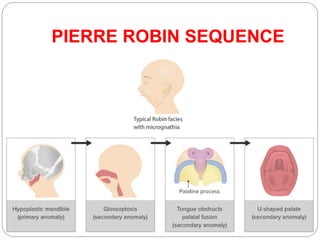 Pierre robin syndrome & Achondroplasia | PPTX | Bone and Joint ...