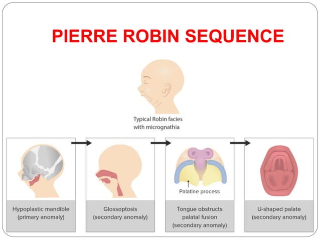 Pierre robin syndrome & Achondroplasia