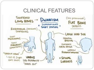 Robin Syndrome And Dwarfism