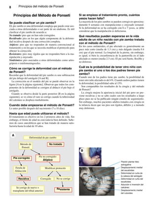 Pie zambo el_mã©todo_ponseti | PDF