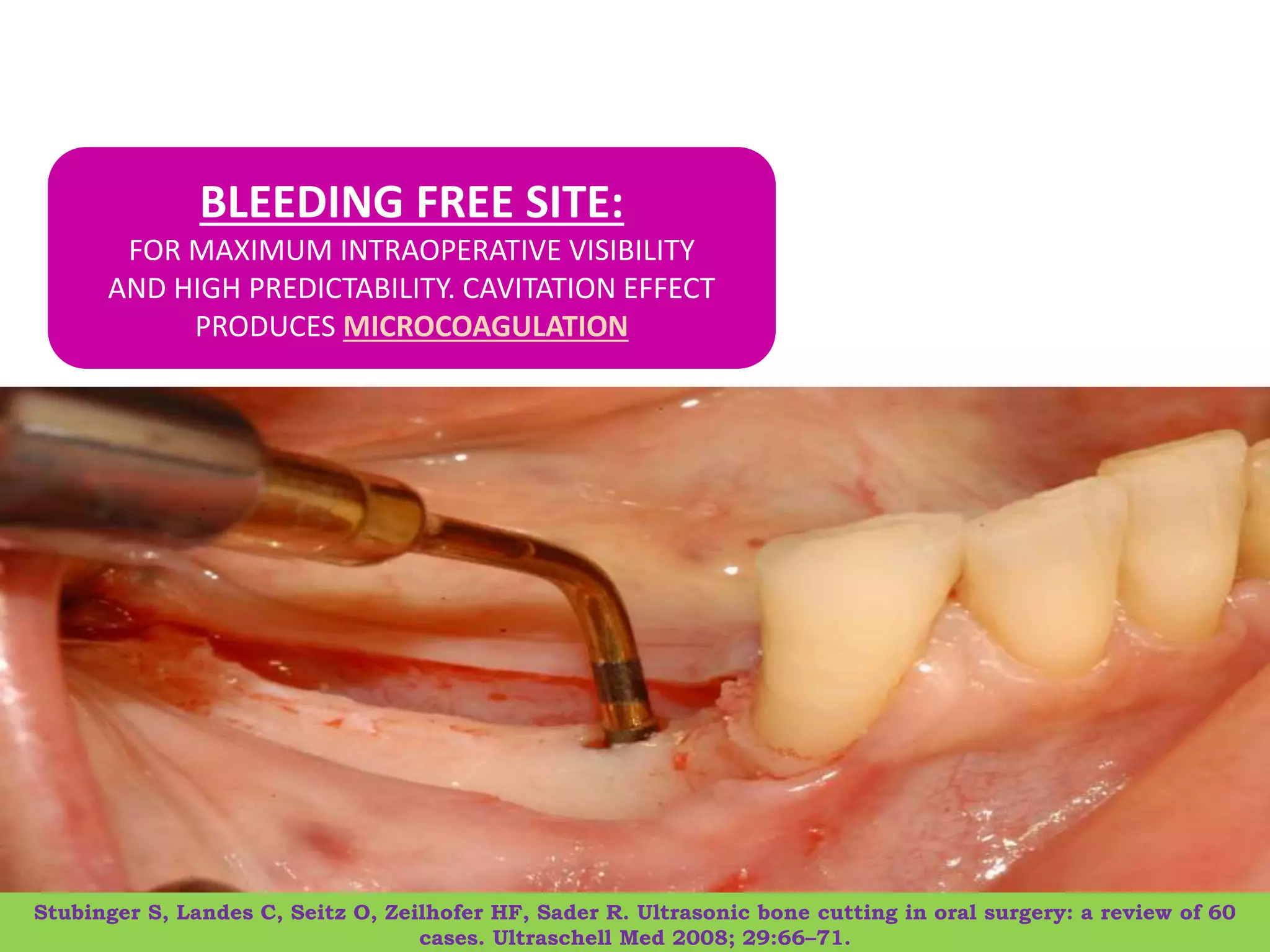 Piezosurgery in periodontics | PPTX