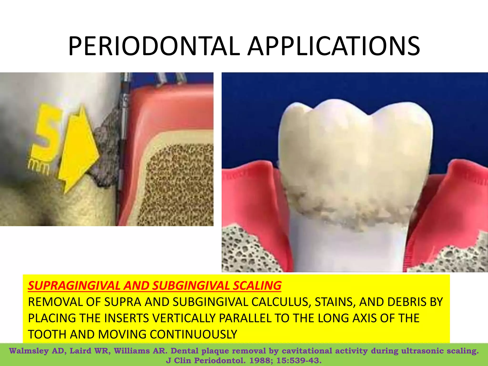 Piezosurgery in periodontics | PPTX