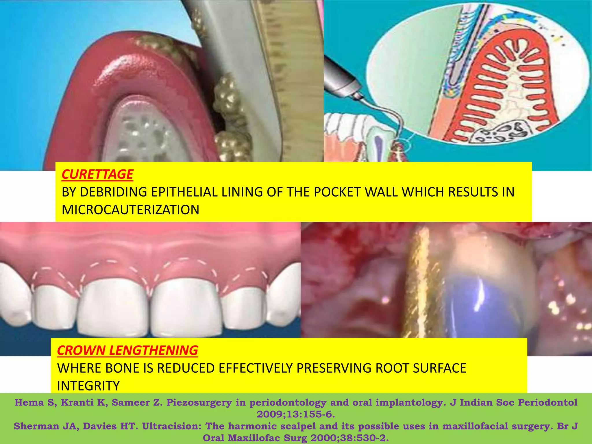 Piezosurgery in periodontics | PPTX