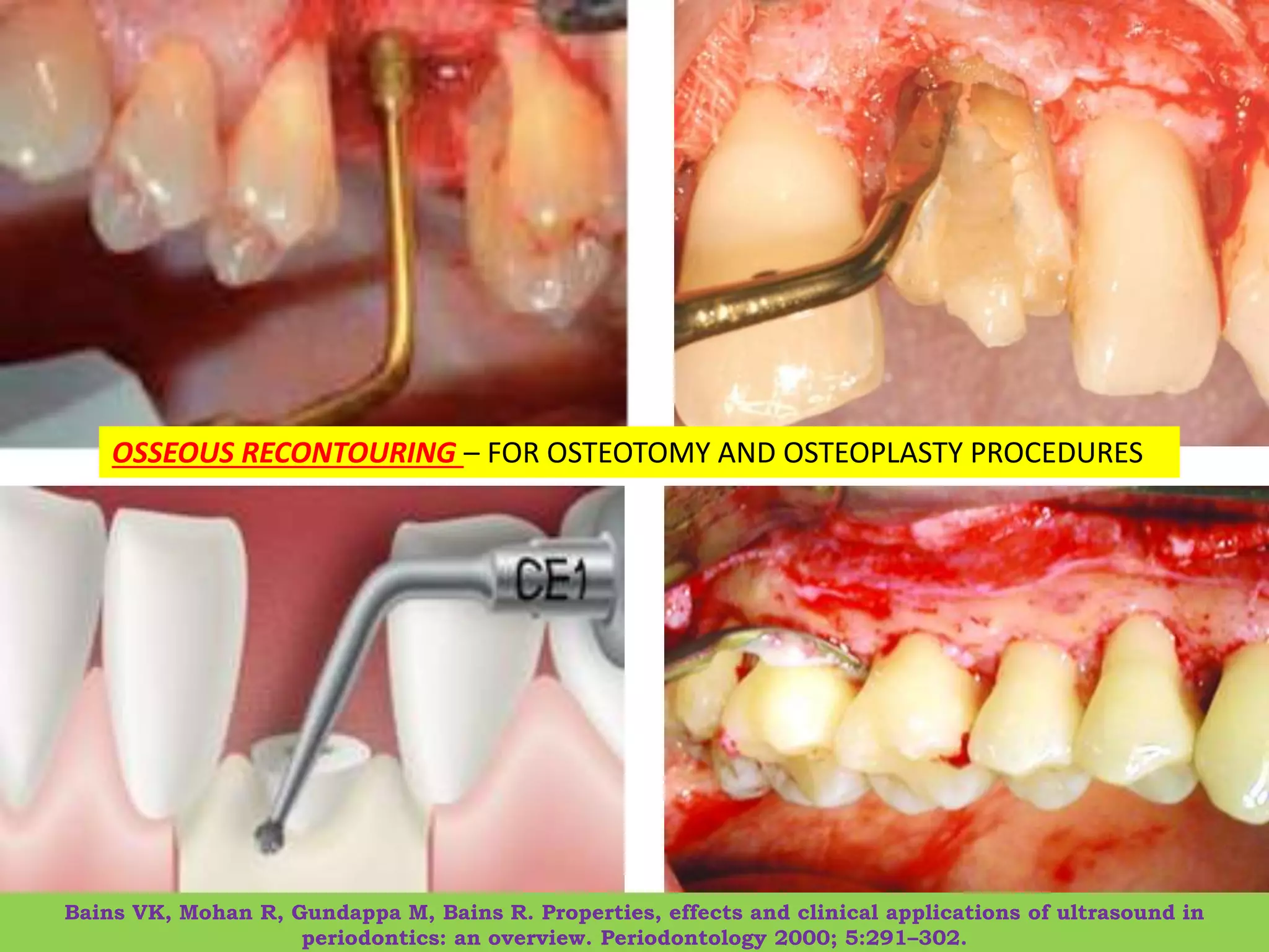 Piezosurgery in periodontics | PPTX