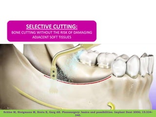 Piezosurgery in periodontics | PPTX