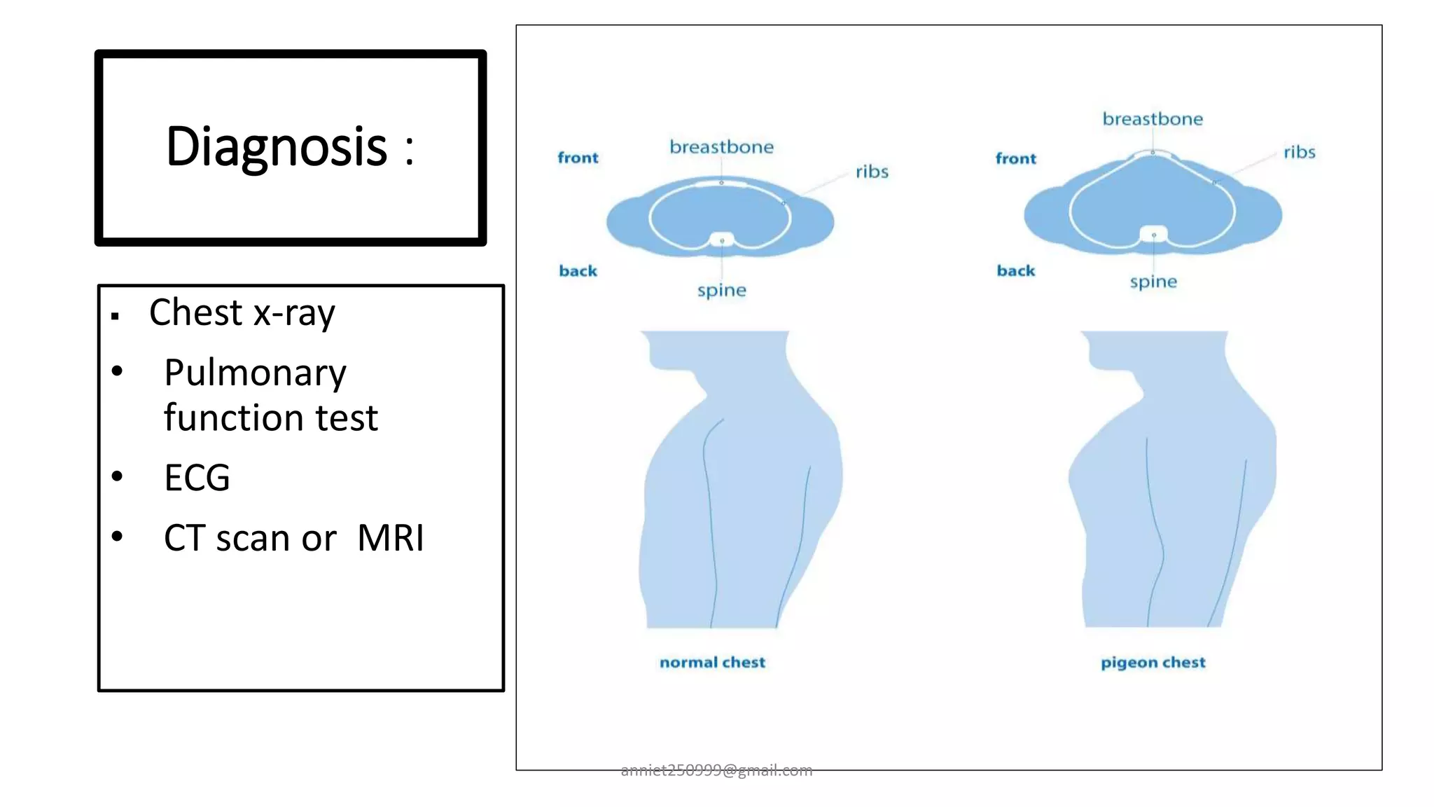 Pigeon chest / Pectus Carinatum | PPTX