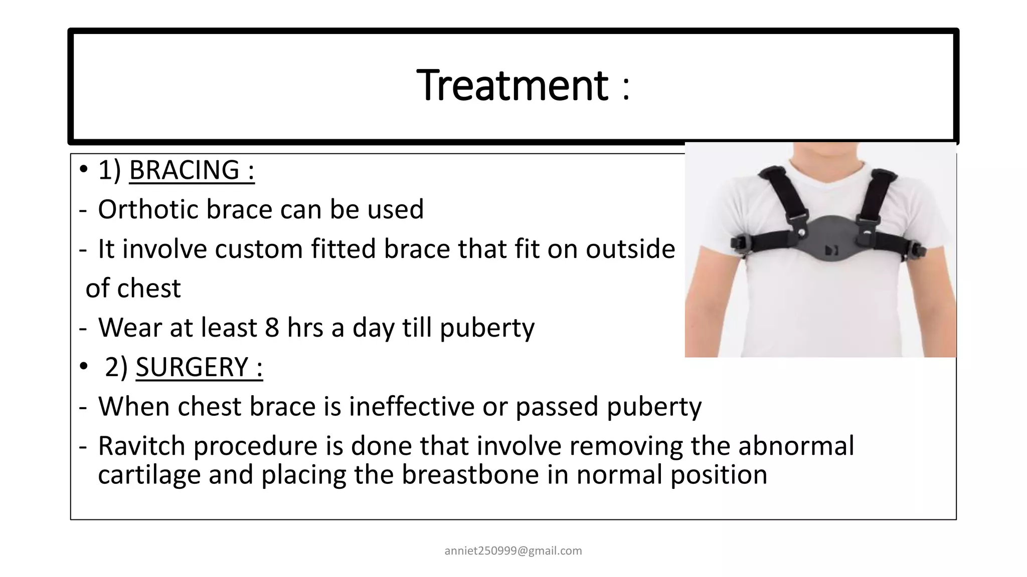Pigeon chest / Pectus Carinatum | PPTX