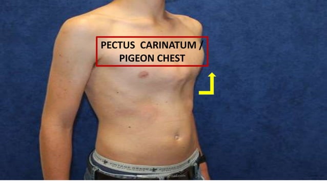 Pigeon chest / Pectus Carinatum | PPTX | Lung and Respiratory Health ...