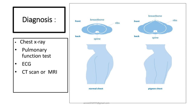 Pigeon chest / Pectus Carinatum