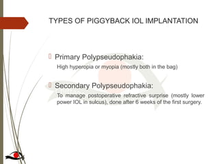 Piggyback iol | PPT