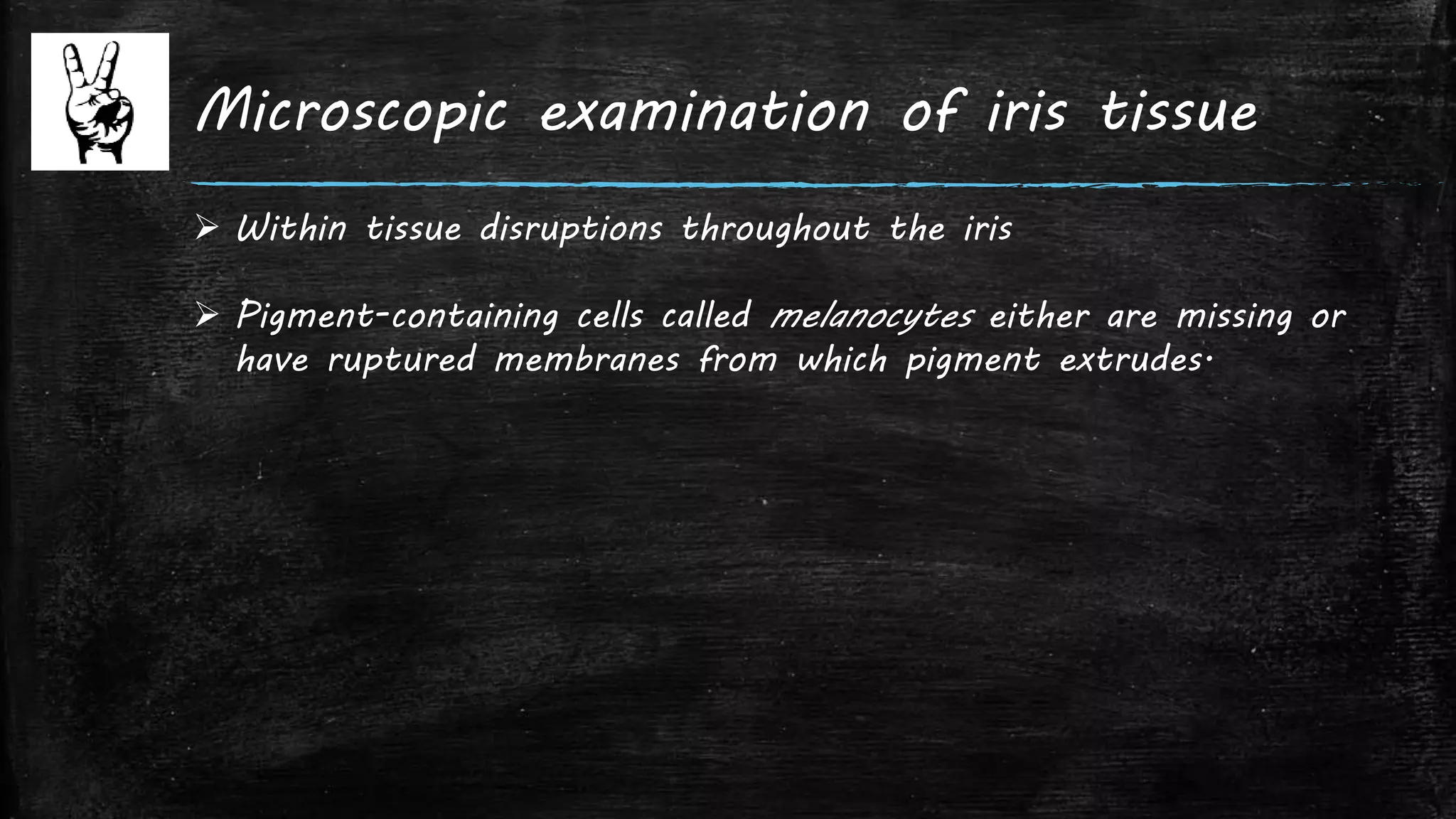 Pigmentary glaucoma - Dr Shylesh B Dabke | PPTX