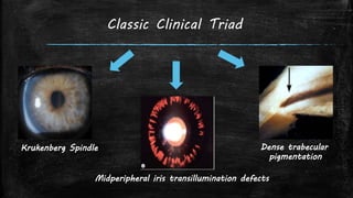 Pigmentary glaucoma - Dr Shylesh B Dabke | PPTX