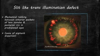 Iris Transillumination Defects