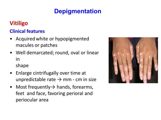 Skin Pigmentation disorders and its management .pptx