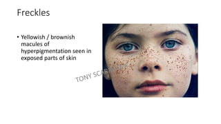 Pigmentation disorders of skin dermatology revision notes | PDF