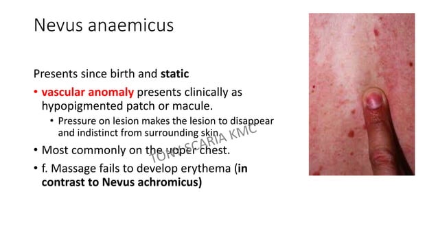 Pigmentation disorders of skin dermatology revision notes | PDF | Skin ...
