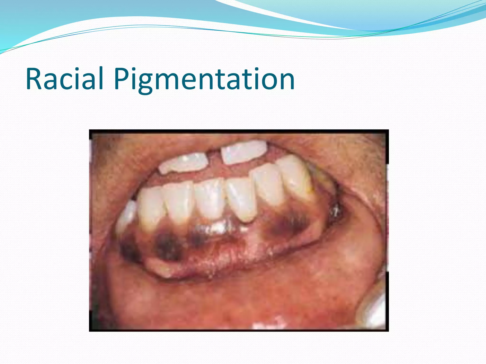 oral Pigmentations | PPTX
