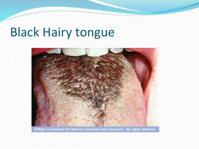 oral Pigmentations