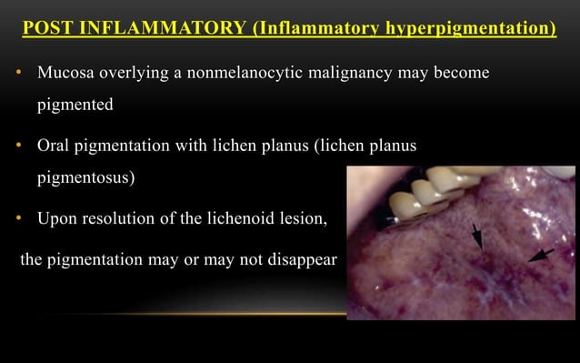 Pigmentations of the oral cavity | PPTX