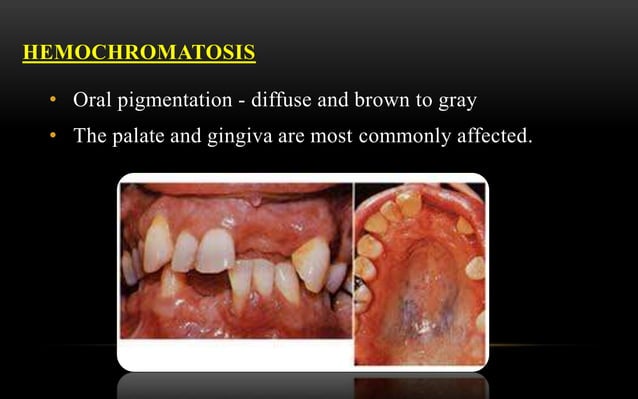 Pigmentations of the oral cavity | PPTX