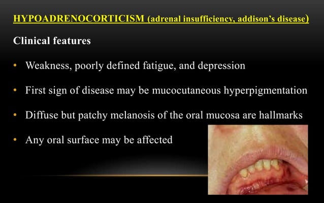 Pigmentations of the oral cavity | PPTX