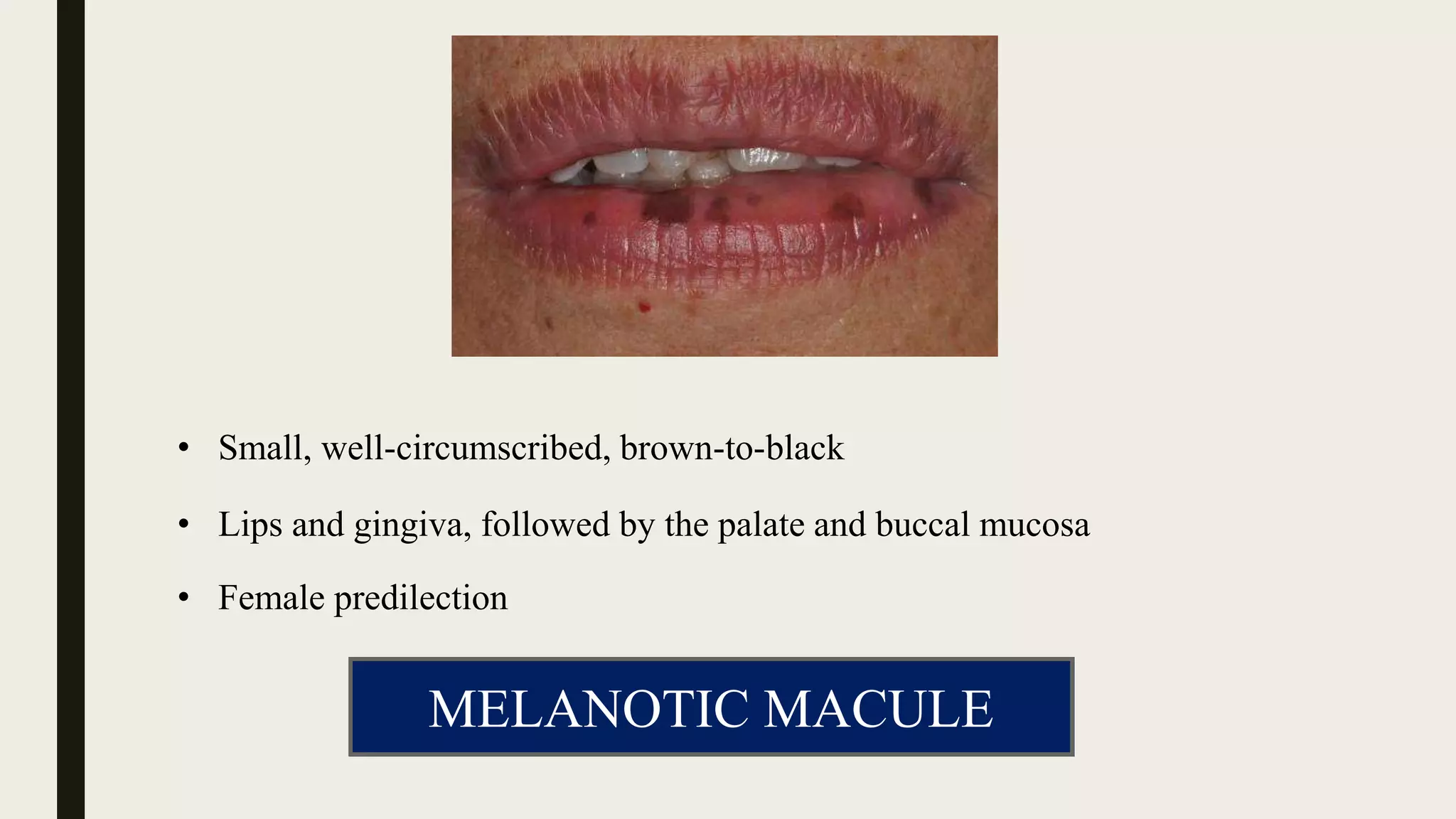 PIGMENTATIONS OF ORAL MUCOSA.pptx