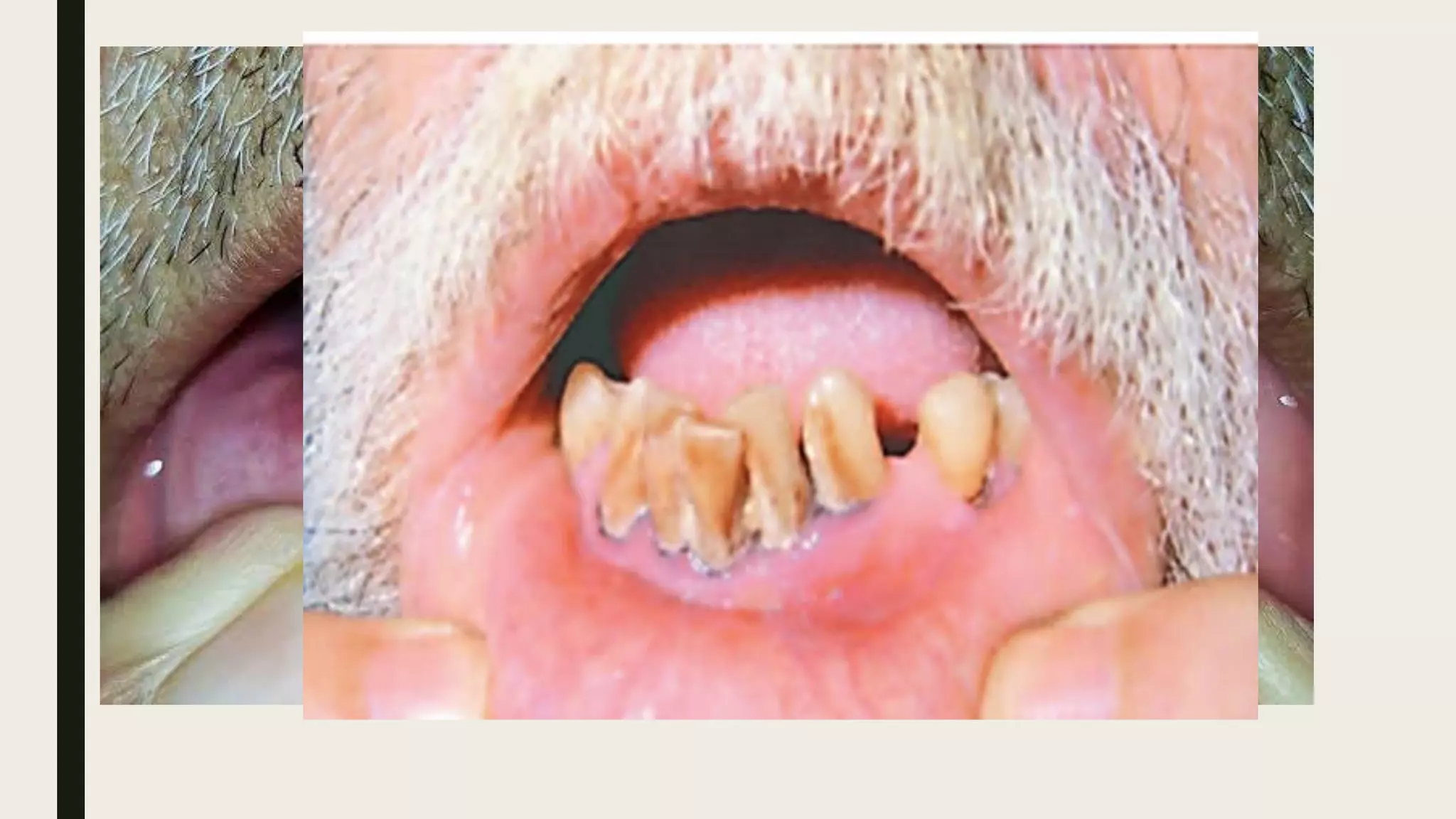 PIGMENTATIONS OF ORAL MUCOSA.pptx