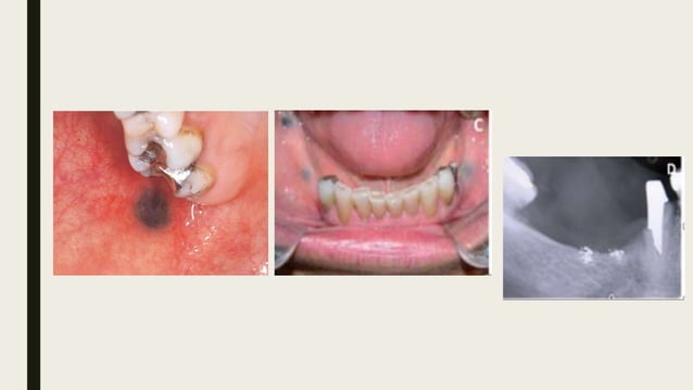 PIGMENTATIONS OF ORAL MUCOSA.pptx | Dental Health | Diseases and Conditions