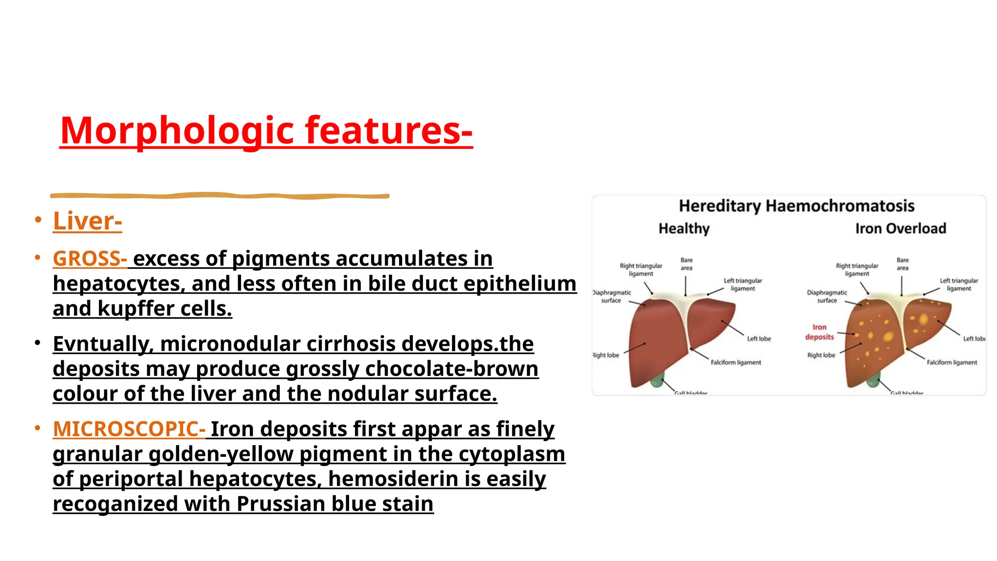Pigment Cirrhosis in Haemochromatosis.pptx