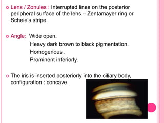 Pigment dispersion syndrome | PPTX