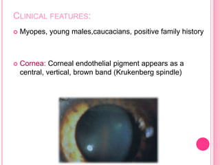 Lines With Iron Pigment Dispersion Syndrome