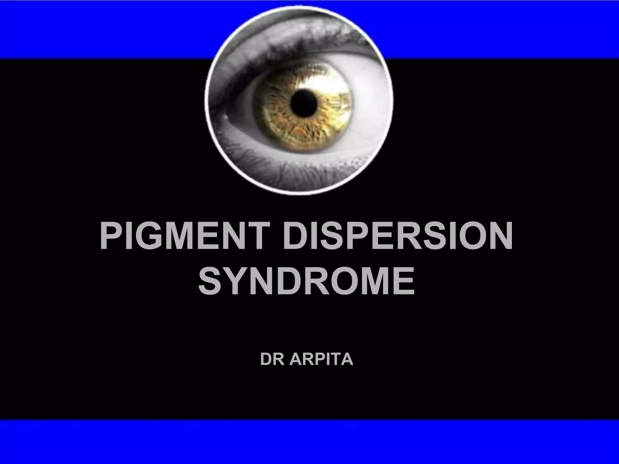 Pigment dispersion syndrome | PPTX