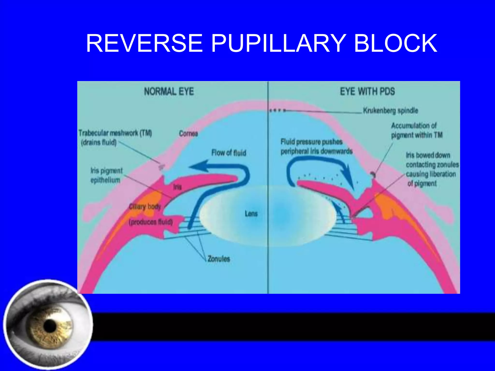 Pigment dispersion syndrome | PPTX
