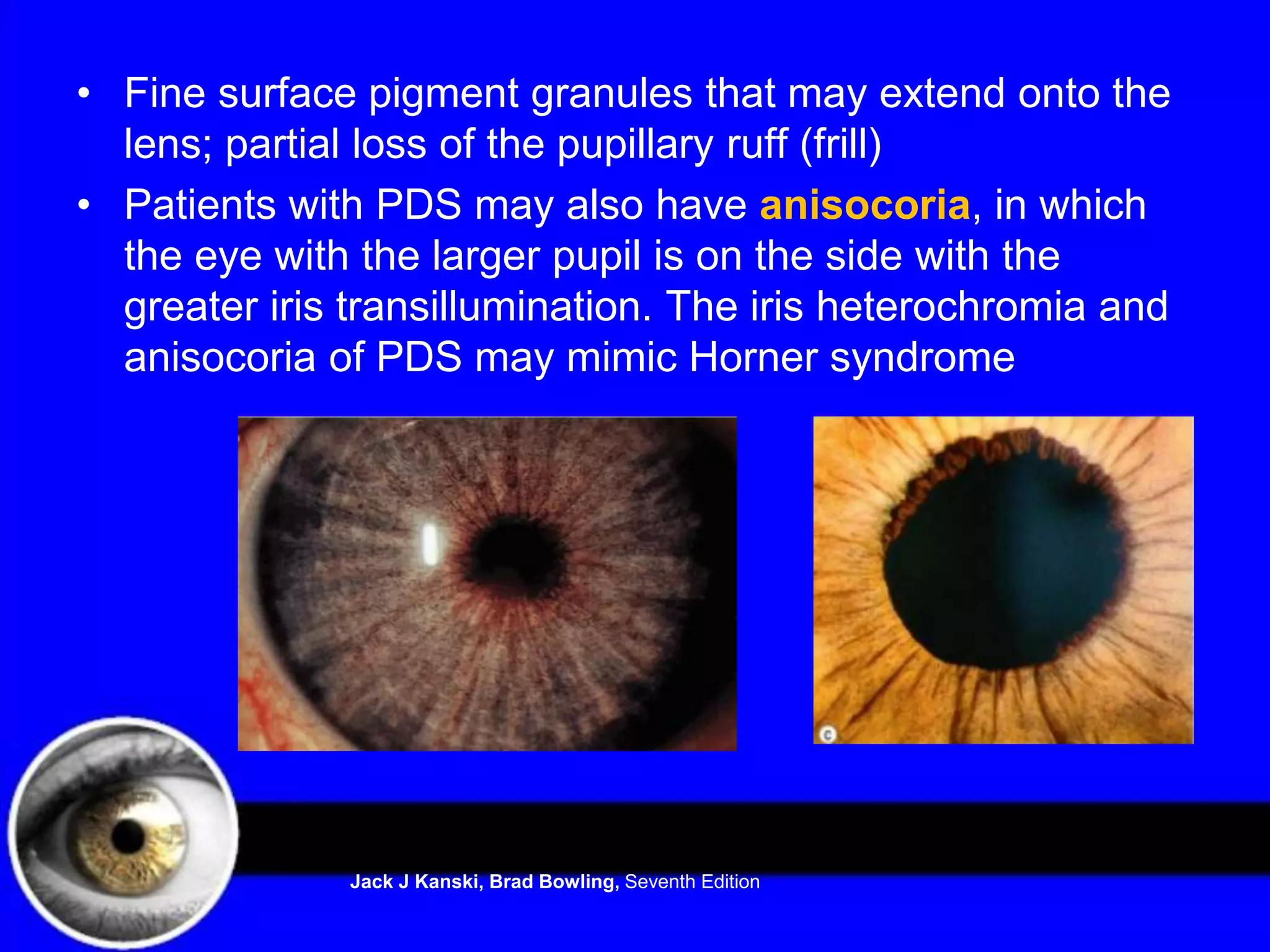 Pigment dispersion syndrome | PPTX