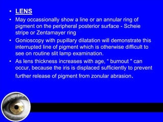 Pigment dispersion syndrome | PPTX
