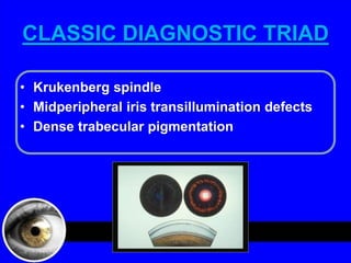 Pigment dispersion syndrome | PPTX