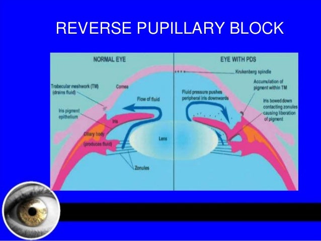 Pigment dispersion syndrome