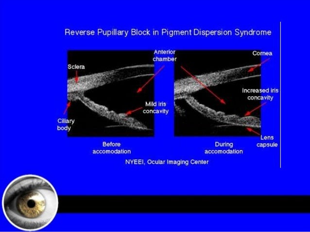 Pigment dispersion syndrome