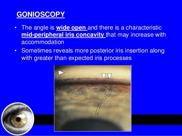 Pigment dispersion syndrome