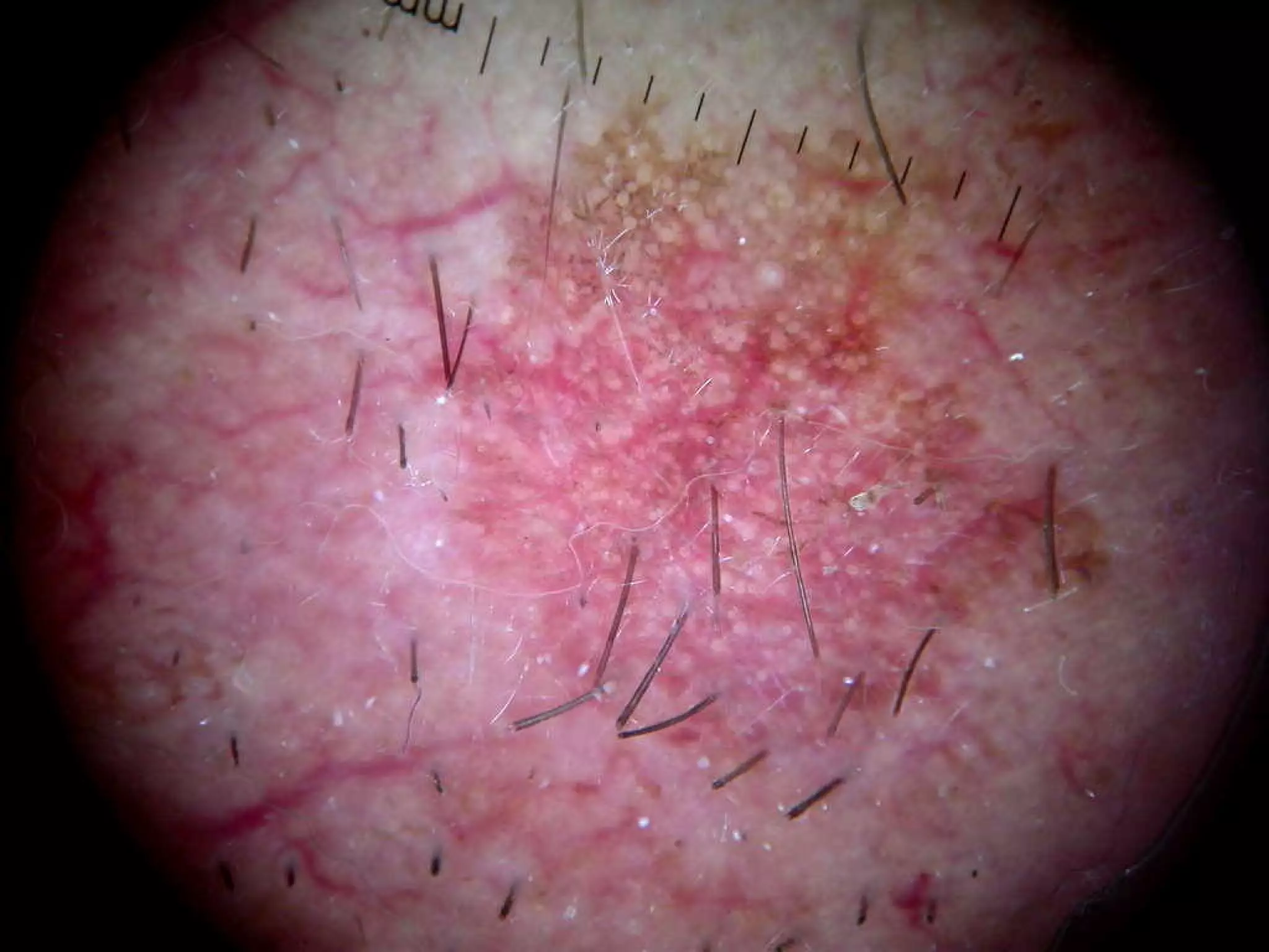 Pigmented actinic keratosis | PPT